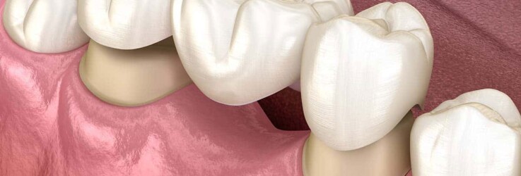 Dental Bridges vs. Implants in Douglasville | Tooth Replacement Options